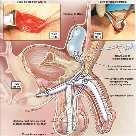 Pump Penile Implant Surgery
