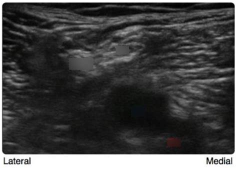 Us Popliteal Block Anatomy Diagram Quizlet