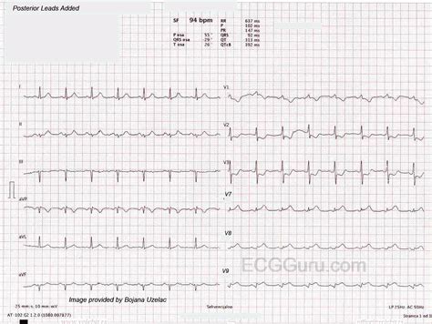 Isolated Posterior Wall Mi Ecg Guru Instructor Resources