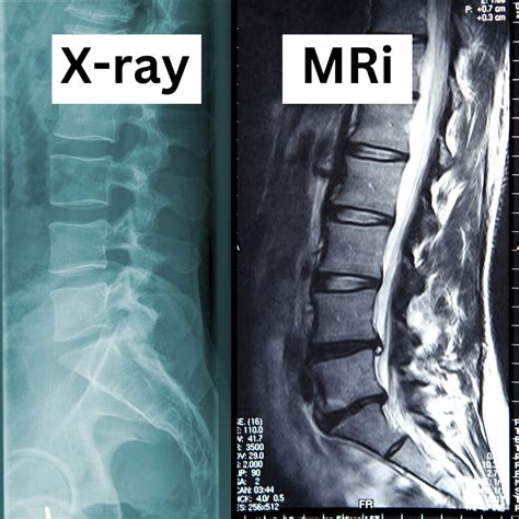 Sciatica Treatment And Investigation Deansgate Osteopath Clinic
