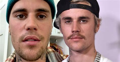 How Did Justin Bieber S Face Get Better After Suffering From Facial Paralysis