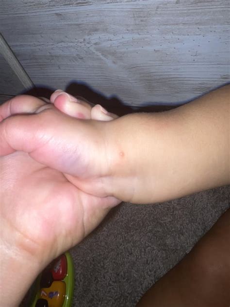 Please Help Is This Scabies On My Penis Pics R Scabies