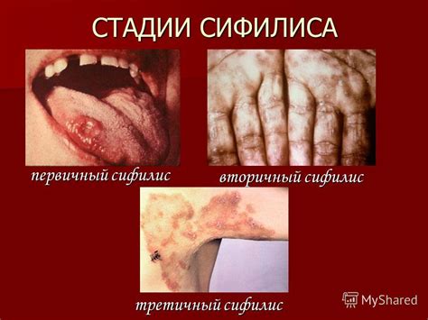 Презентация на тему Венерические заболевания это болезни