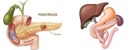 Pancreaticojejunostomy