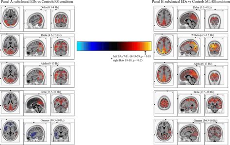 Results Of The Eloreta Comparison Of Eeg Power Spectra In Each Download Scientific Diagram