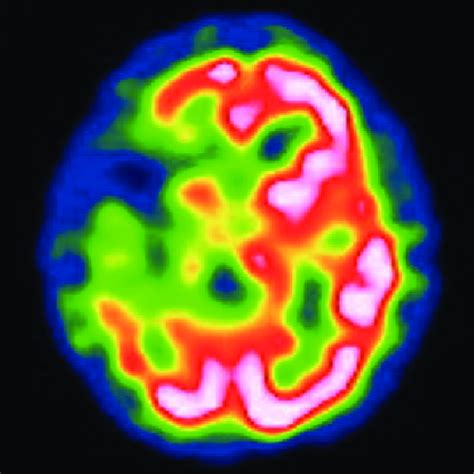 Brain Single Photon Emission Computed Tomography Reveals Large