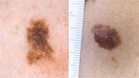 Skin Savvy Mastering The Art Of Skin Cancer Self Checks Queensland