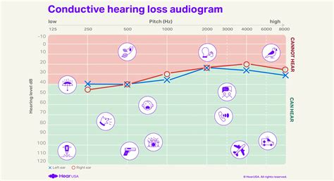 Conductive Hearing Loss Audiogram Example Conductive Hearing Loss