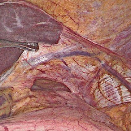 Intraoperative View Download Scientific Diagram