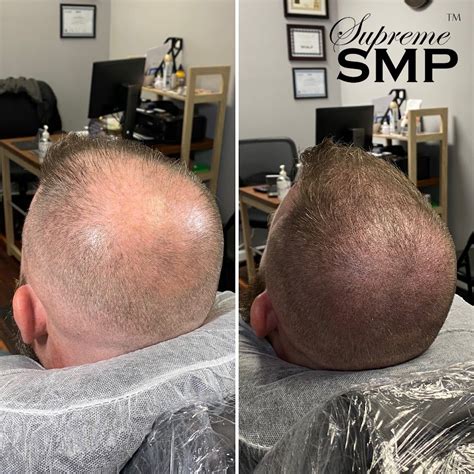 Hair Density Treatment Massachusetts Usa Supreme Smp