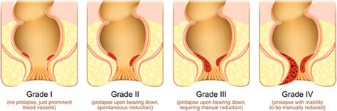 The Hemorrhoids Grading System Guide Hemorrhoid Grade Scale 1 2 3