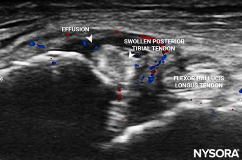 Case Study Ankle Joint Effusion Injection Nysora Case Study Ankle Joint Effusion Injection Nysora