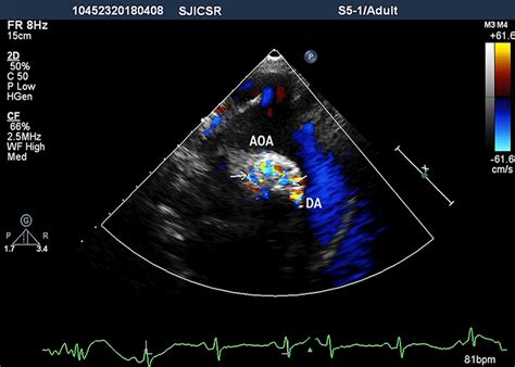 Suprasternal View Demonstrating Multiple Collaterals Arrows Aoa