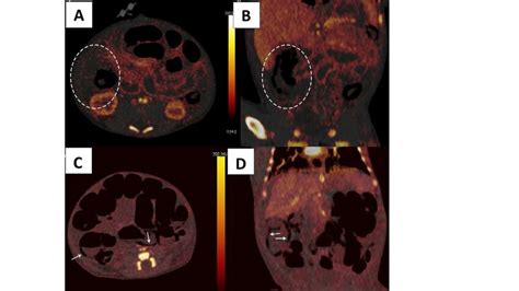 Flow Chart Of Treatment And Outcomes For The 34 Patients Presenting