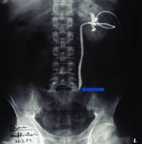 Left Antegrade Pyelogram Showing Complete Cut Off At Upper Border Of Download Scientific