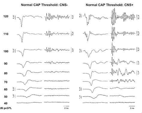 Figure 2 From Cochlear Microphonic Potential Recorded By Transtympanic