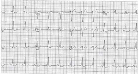 Electrocardiogram Showing A Normal Sinus Rhythm Pr Interval 126 Ms