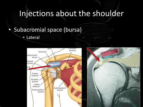 Ppt Injections About The Shoulder Powerpoint Presentation Free Download Id 6703308