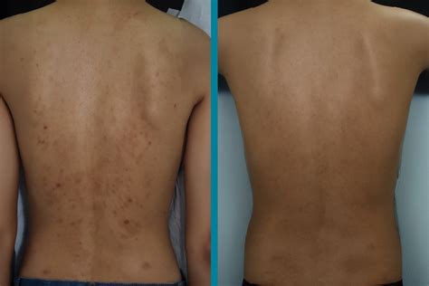 Acne Scars On Back