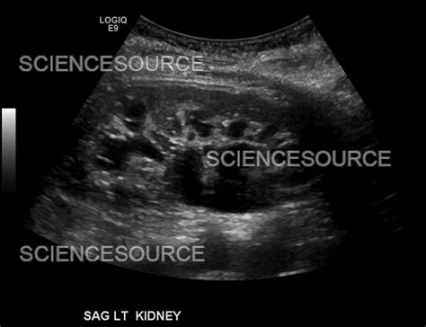 Hydronephrosis Ultrasound