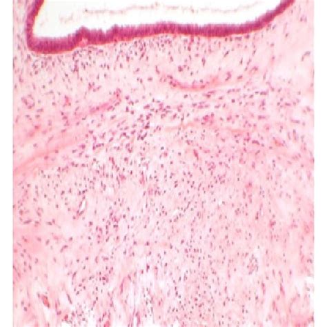 Pdf Phyllodes Tumor Review Article