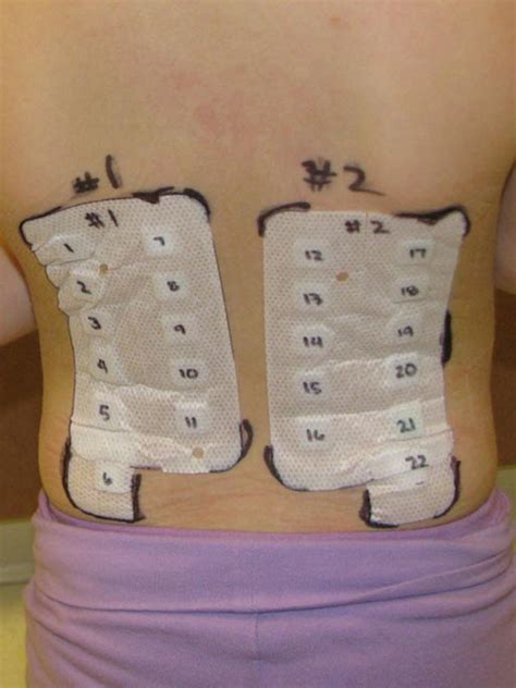 My Food Allergic Babe Atopy Patch Testing Apt