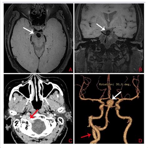 Axial Plain Ct Image Showing Aneurysmal Clipping Of Left Mca Aneurysm