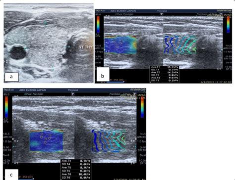 Thyroid Gland Ultrasound Protocol At Catherine Dorsey Blog