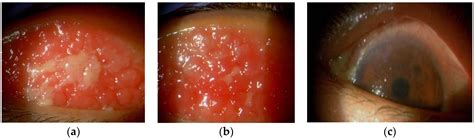 Atopic Keratoconjunctivitis Management Of Vernal Keratoconjunctivitis