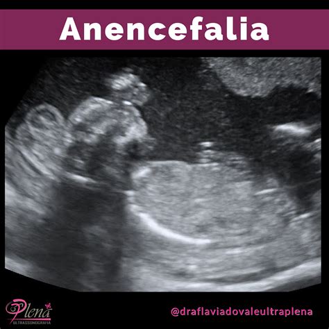 Anencefalia