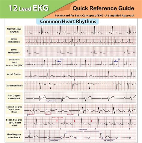 Approach To Ecg Interpretation Learn The Heart 51 Off