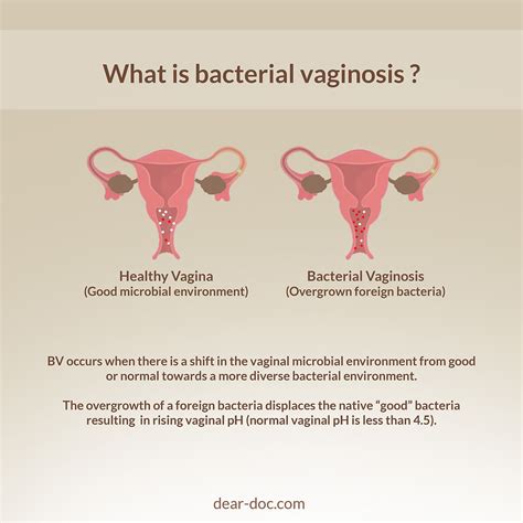 Understanding Vaginal Infections Bacterial Vaginosis