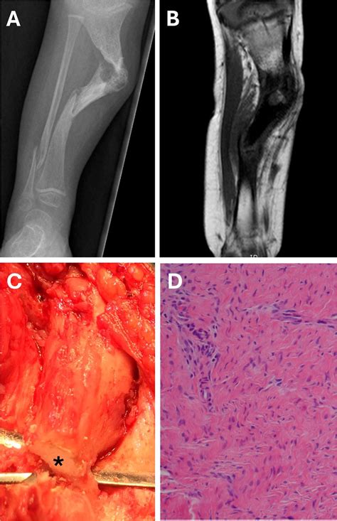 Congenital Pseudarthrosis Of The Tibia A Comprehensive Literature… The Journal Of Bone And