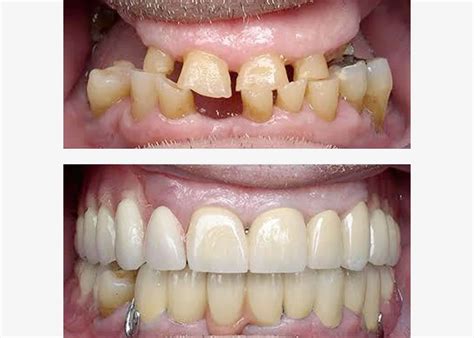 Full Mouth Rehabilitation In Delhi Kamal Dental Clinic
