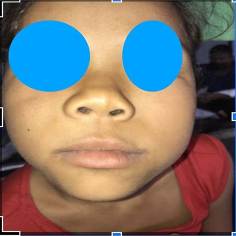 Right Maxillary Canine With Large Dilaceration Root And Orthodontic