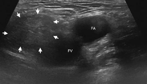 Ultrassonografia De Hernia Femoral
