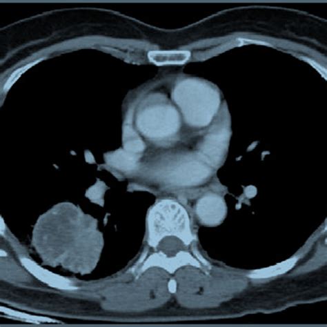 Ct Scan Showing The Mass In The Right Lower Lung Download Scientific