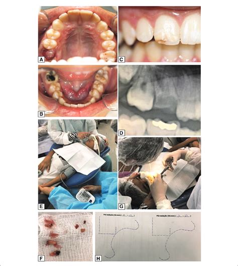 A C Clinical Images Showing Enamel Defect On Teeth 11 26 And 36