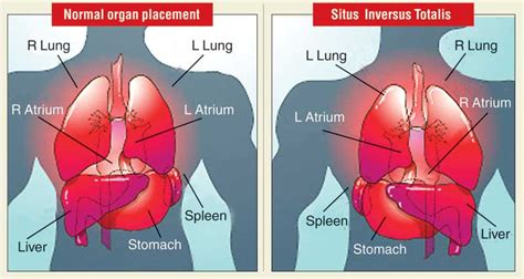 Situs Inversus Patient Represents India In The Asian Roll Ball