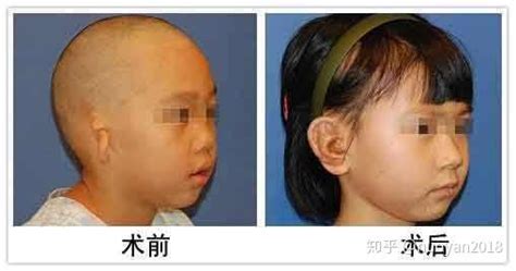 新生儿先天性小耳畸形 知乎