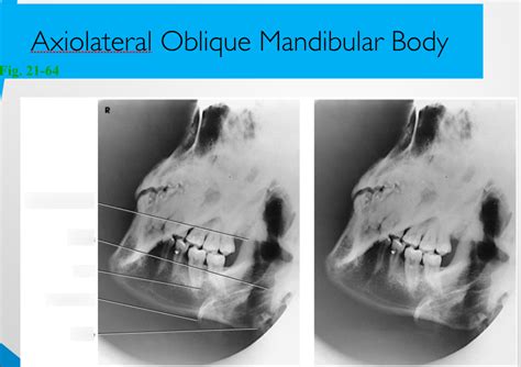 Oblique Lateral Radiograph