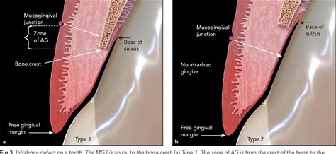 Figure 3 From A New Definition Of Attached Gingiva Around Teeth And