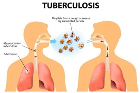 Myrspik Pulmonary Tuberculosis Tb
