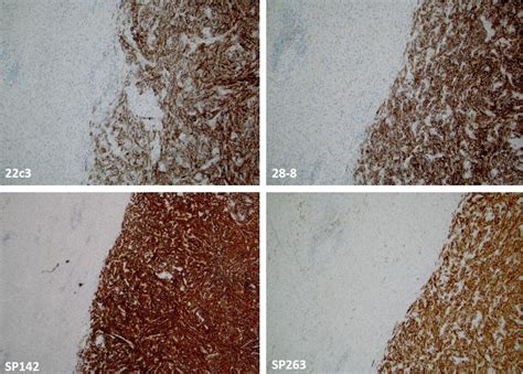 Figure 1 From Pd L1 Testing By Immunohistochemistry In Immuno Oncology Semantic Scholar