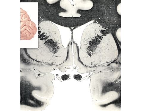 Telencephalon And Diencephalon Slice 1 Quiz