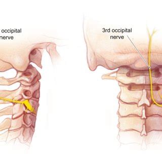 An Anteroposterior Radiograph Of Needle Placement For Third Occipital