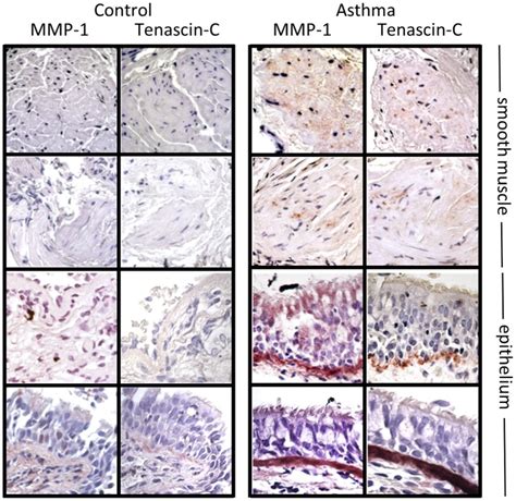 Endobronchial Biopsies From Seven Patients With Asthma And Five Download Scientific Diagram