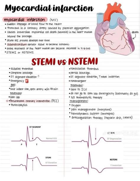 Ekg Ecg Artofit