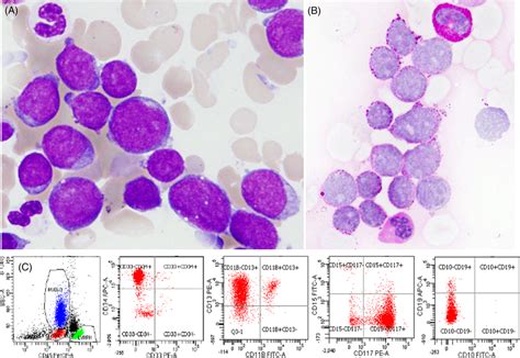 A Blasts In A Case Of Aml M0 Resemble Lymphoblasts With Scant