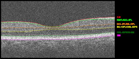 Demonstration Of The Segmentation Of 5 Inner Retinal Layers For The